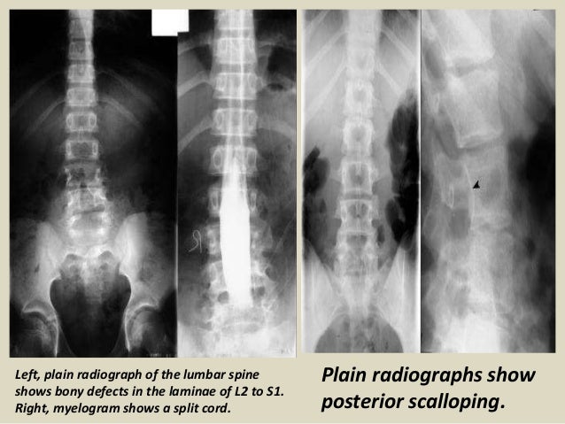 Presentation1.pptx, radiological imaging of spinal dysraphism.