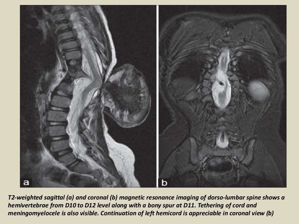 Presentation1.pptx, radiological imaging of spinal dysraphism.