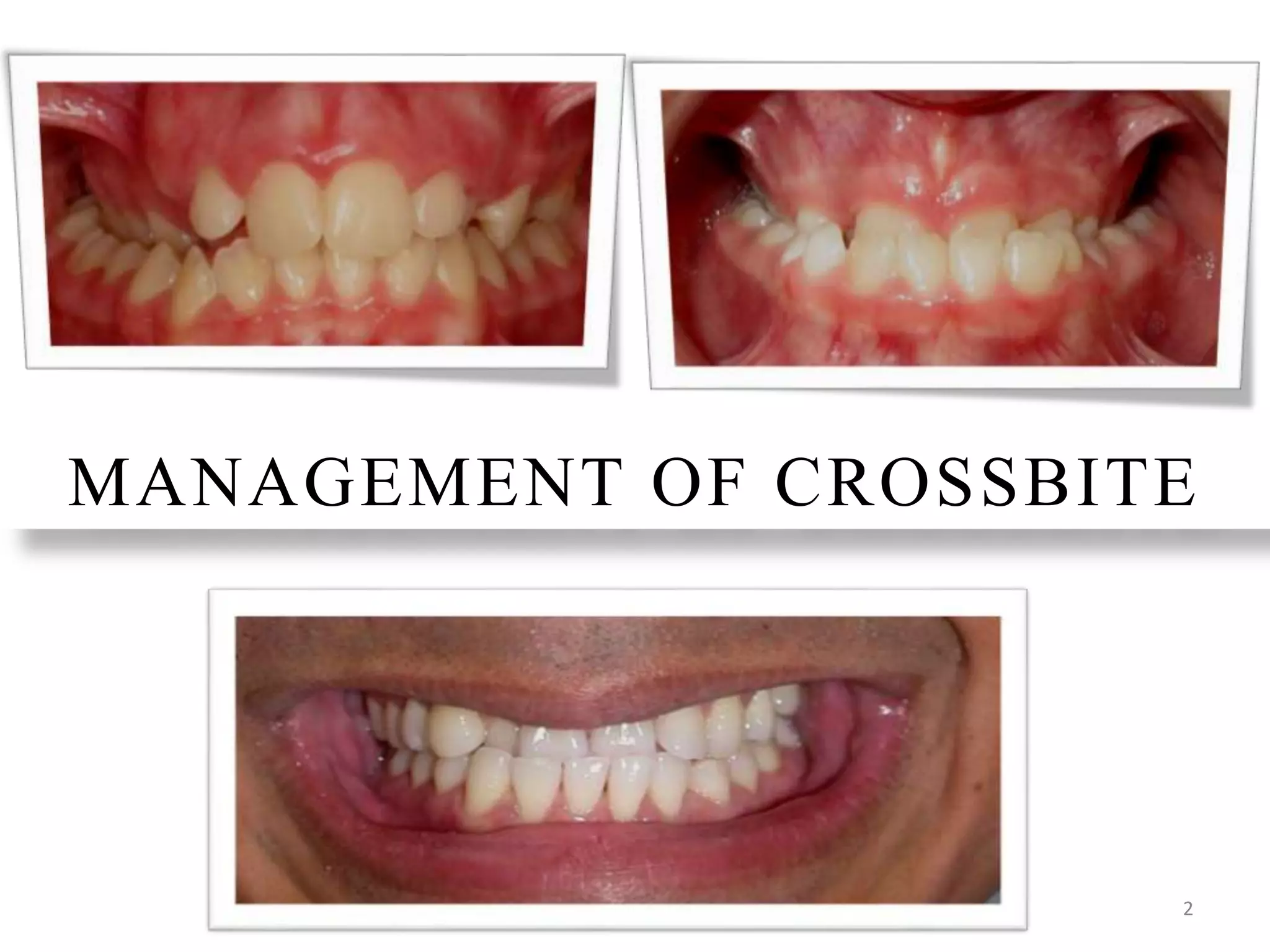 crossbite management in restorative dentistry | PPTX