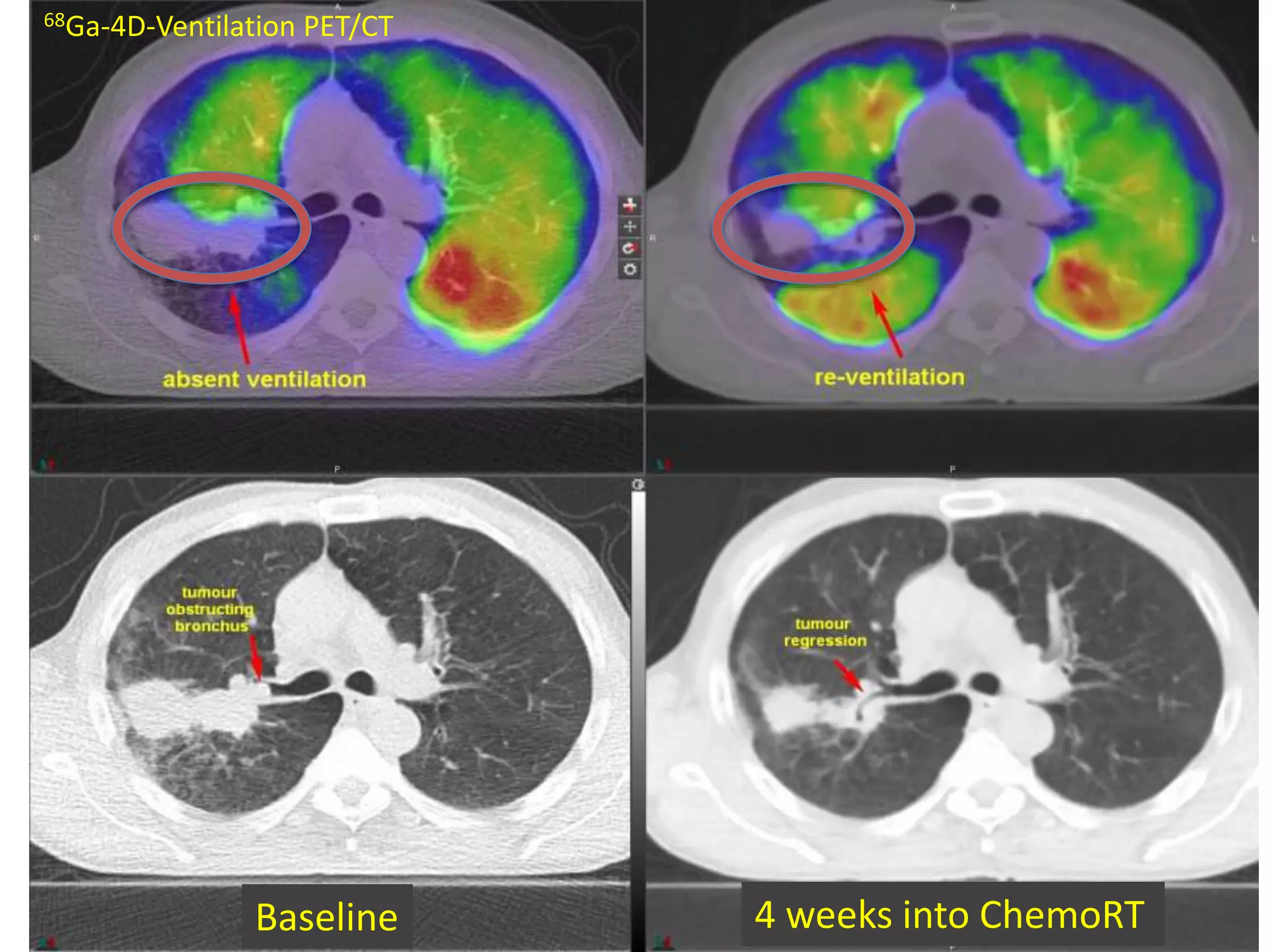 Ventilation PET | PPTX