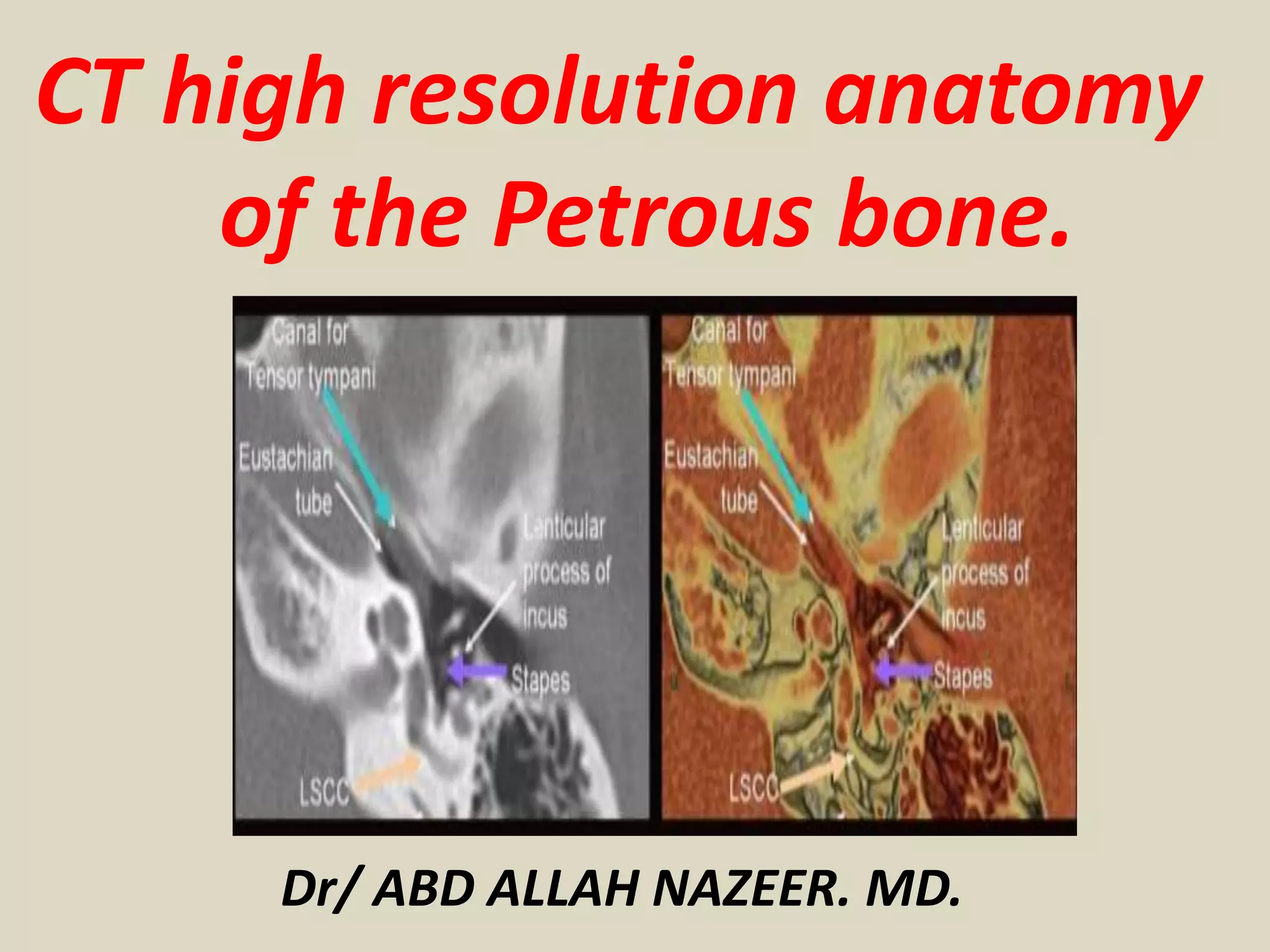 Presentation1.pptx, ct high resolution anatomy of the petrous bone. | PPTX | Bone and Joint ...