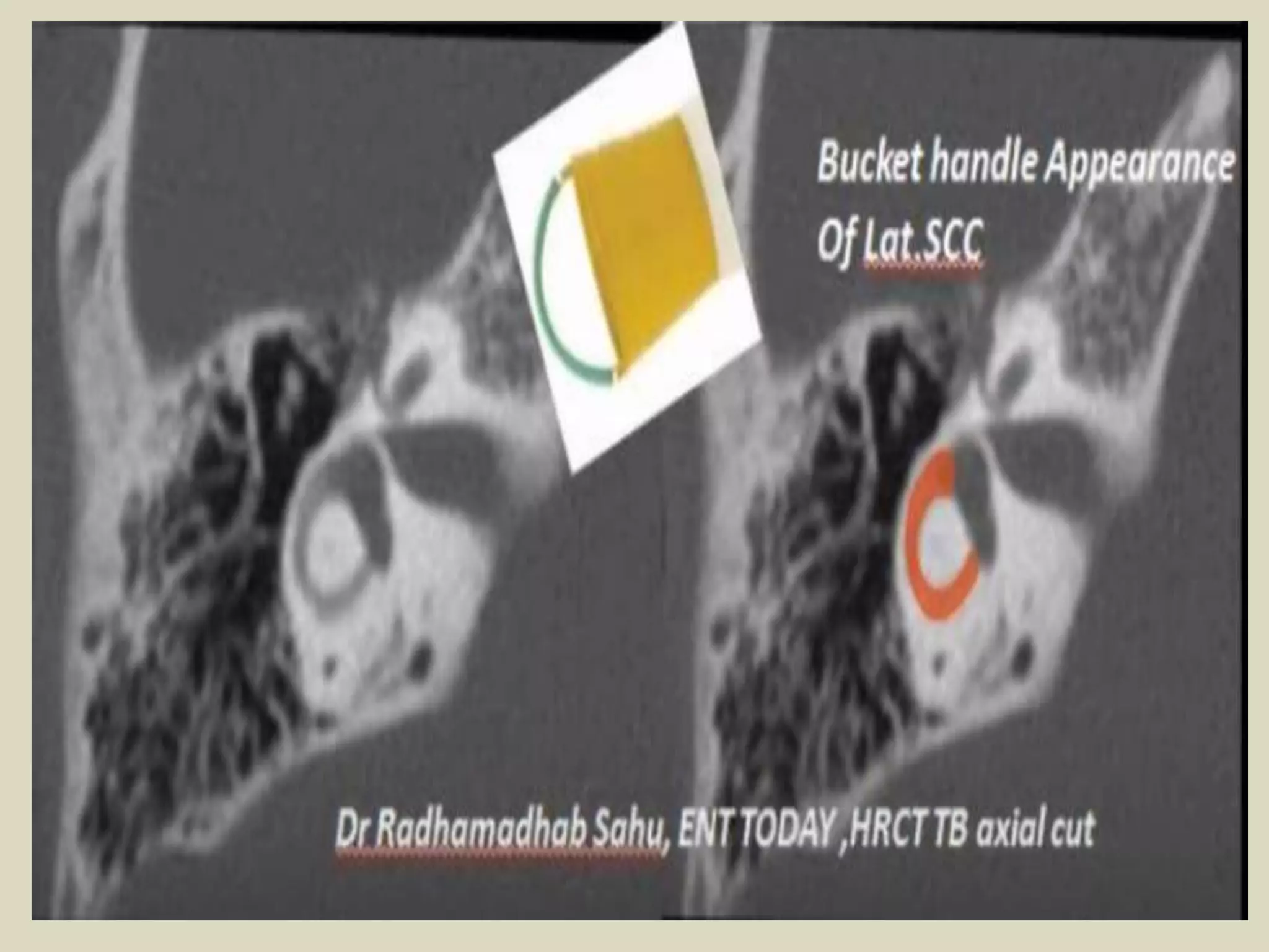 Presentation1.pptx, ct high resolution anatomy of the petrous bone ...