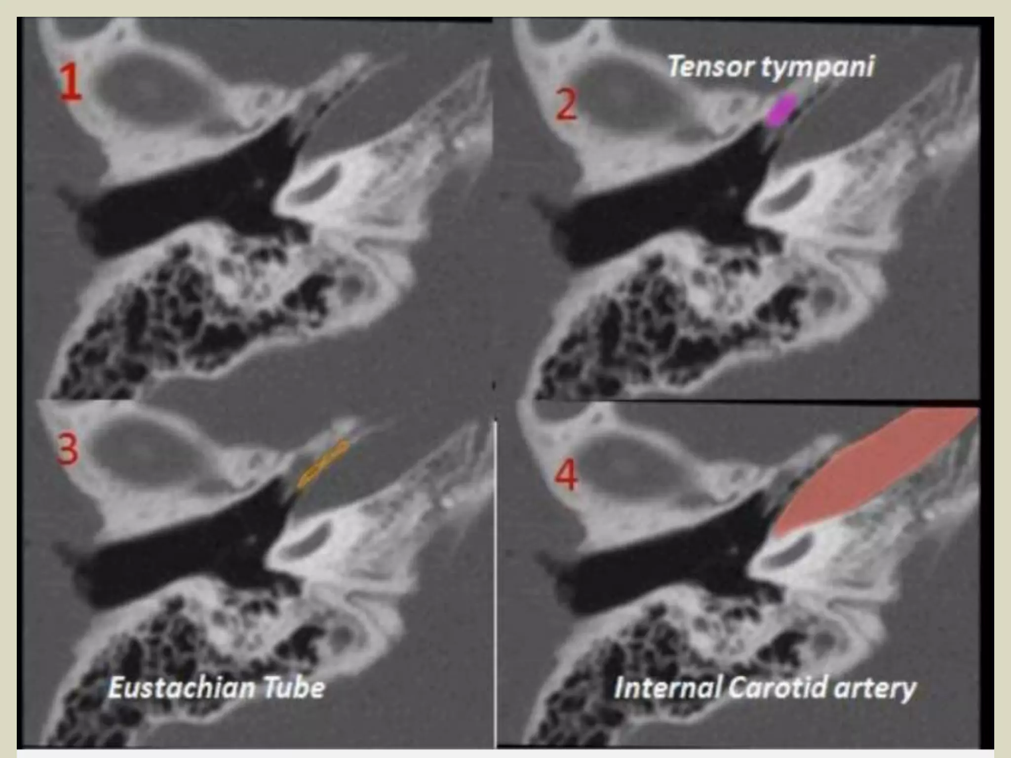 Presentation1.pptx, ct high resolution anatomy of the petrous bone ...