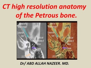 Presentation1.pptx, ct high resolution anatomy of the petrous bone. | PPTX