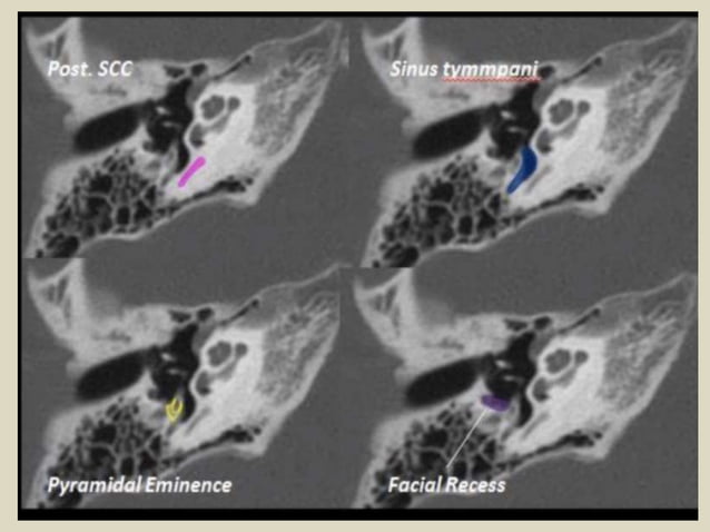 Presentation1.pptx, ct high resolution anatomy of the petrous bone ...