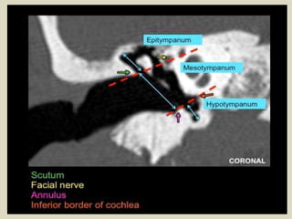 Presentation1.pptx, ct high resolution anatomy of the petrous bone. | PPTX