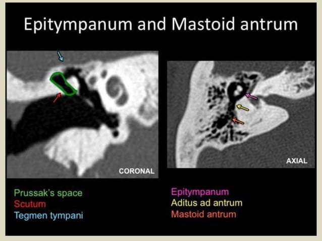 Presentation1.pptx, ct high resolution anatomy of the petrous bone ...