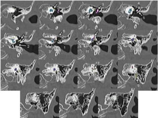 Presentation1.pptx, ct high resolution anatomy of the petrous bone. | PPTX