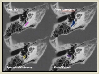 Pyramidal Eminence Ct
