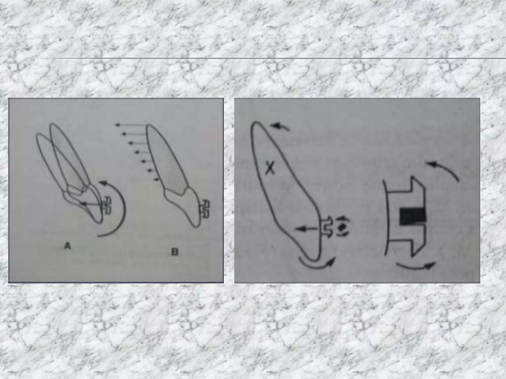 Torque in orthodontics | PPTX