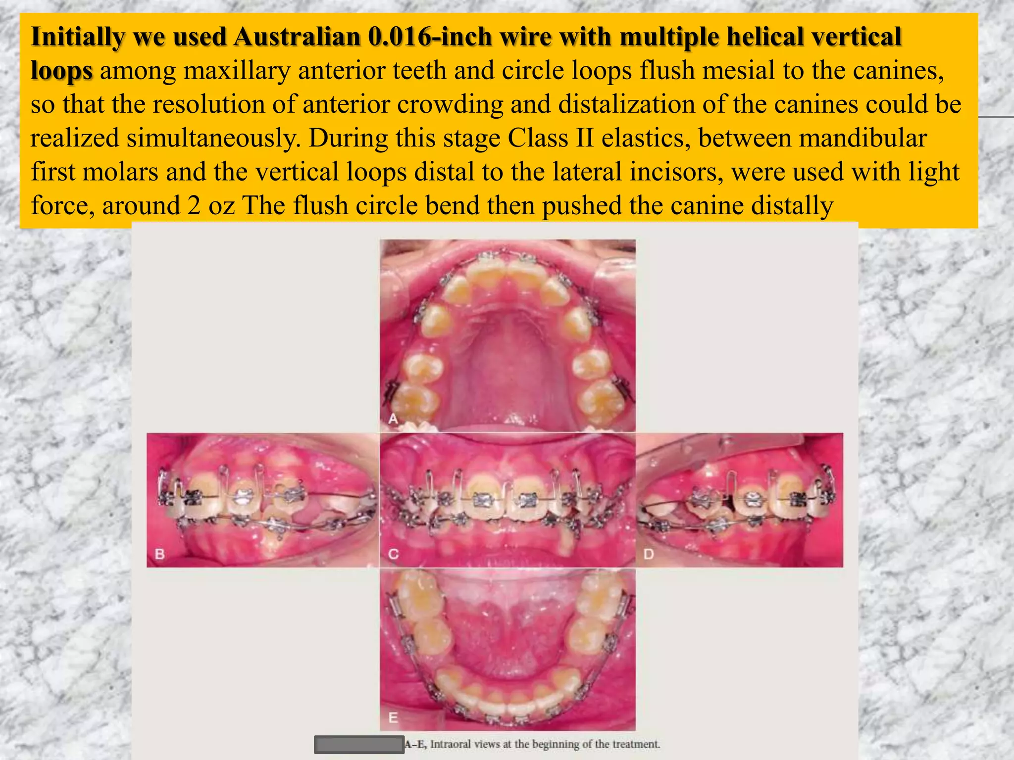 Torque in orthodontics | PPTX