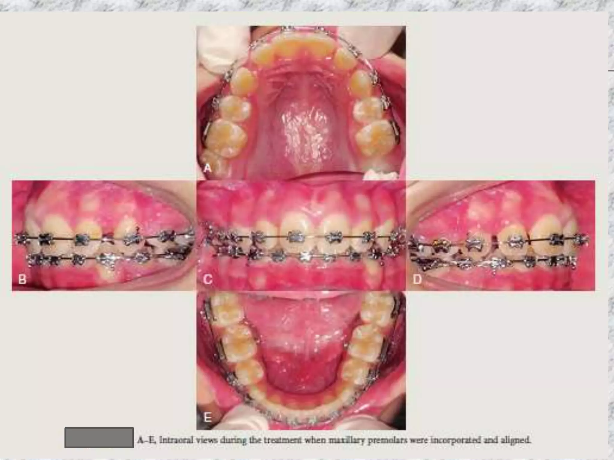 Torque in orthodontics | PPTX