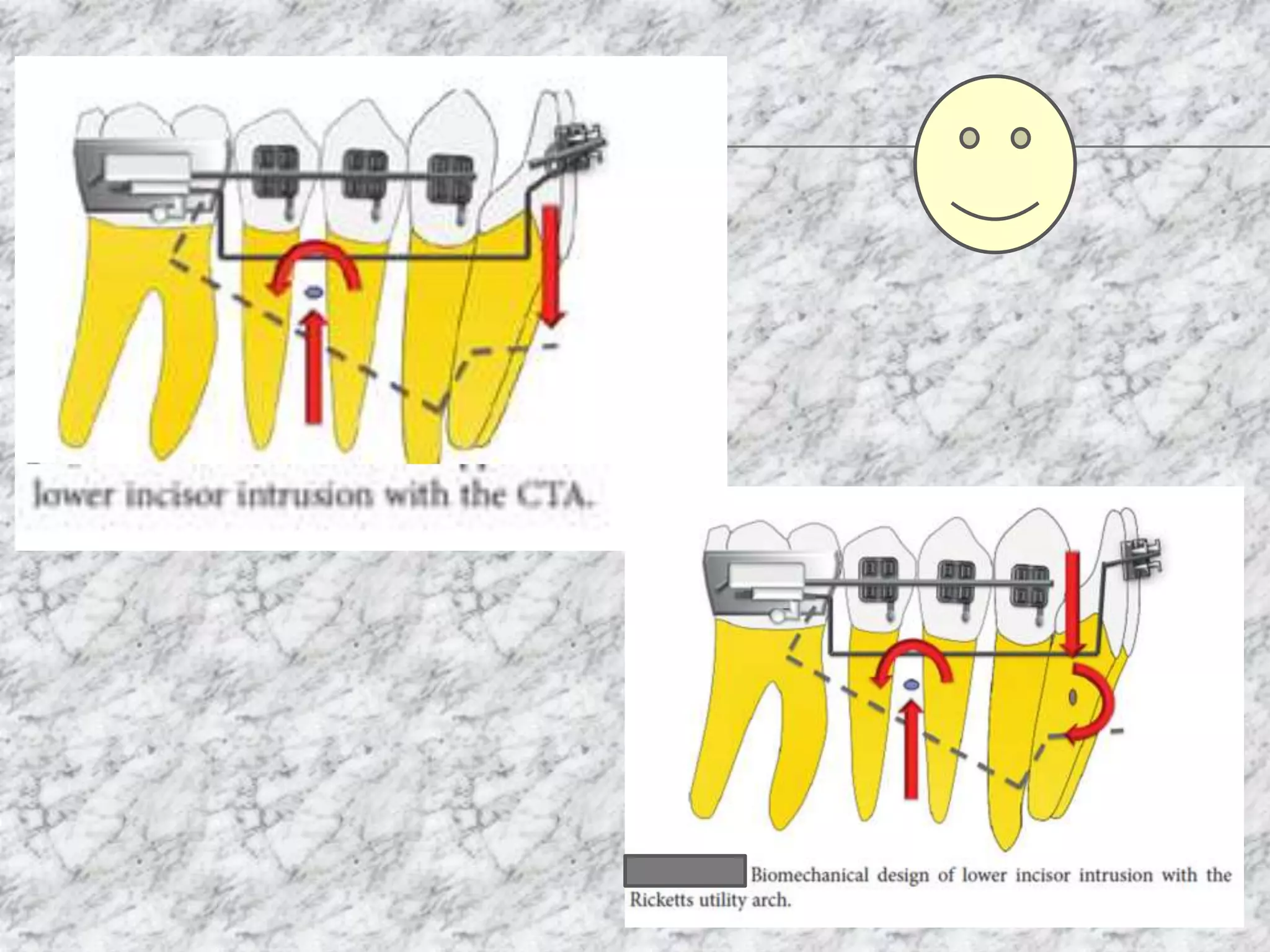 Torque in orthodontics | PPTX