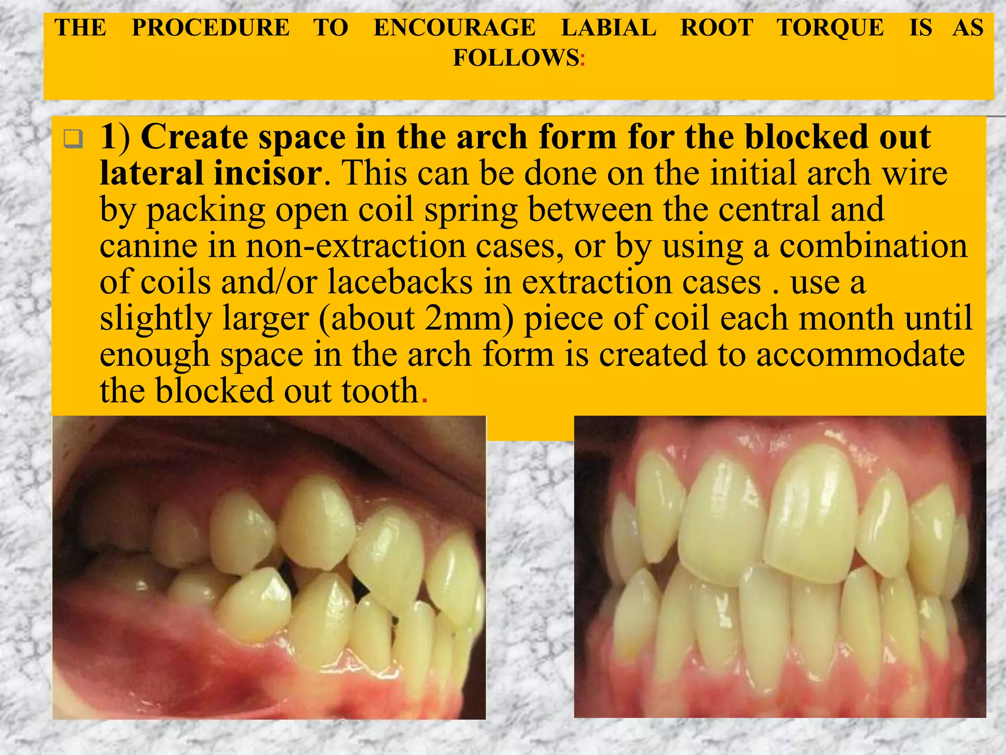 Torque in orthodontics | PPTX