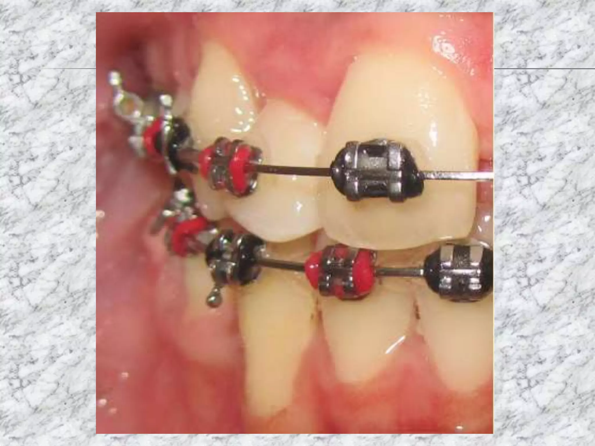 Torque in orthodontics | PPTX