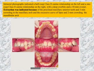 Torque in orthodontics | PPTX