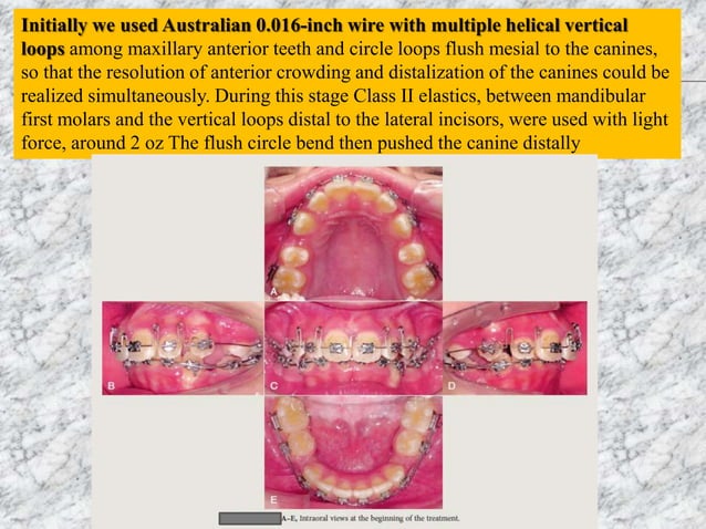 Torque in orthodontics | PPTX