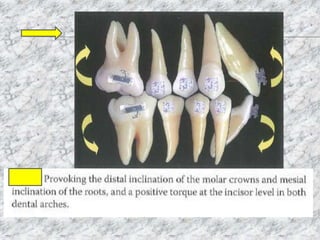 Torque in orthodontics | PPTX