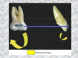 Torque in orthodontics | PPTX