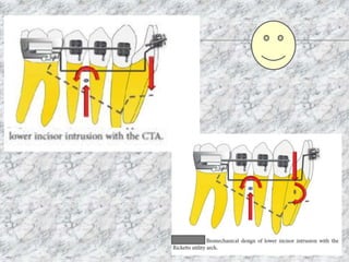 Torque in orthodontics | PPTX