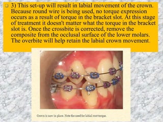 Torque in orthodontics | PPTX