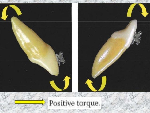 Torque in orthodontics