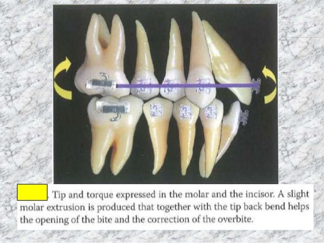 Torque in orthodontics