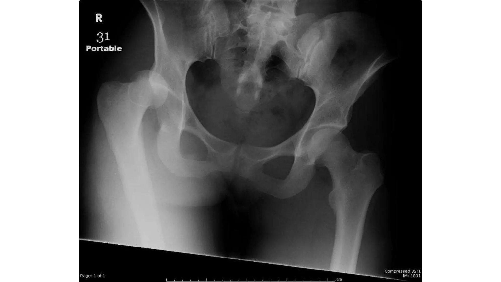 Photo Session: Posterior Hip Dislocation | PPTX