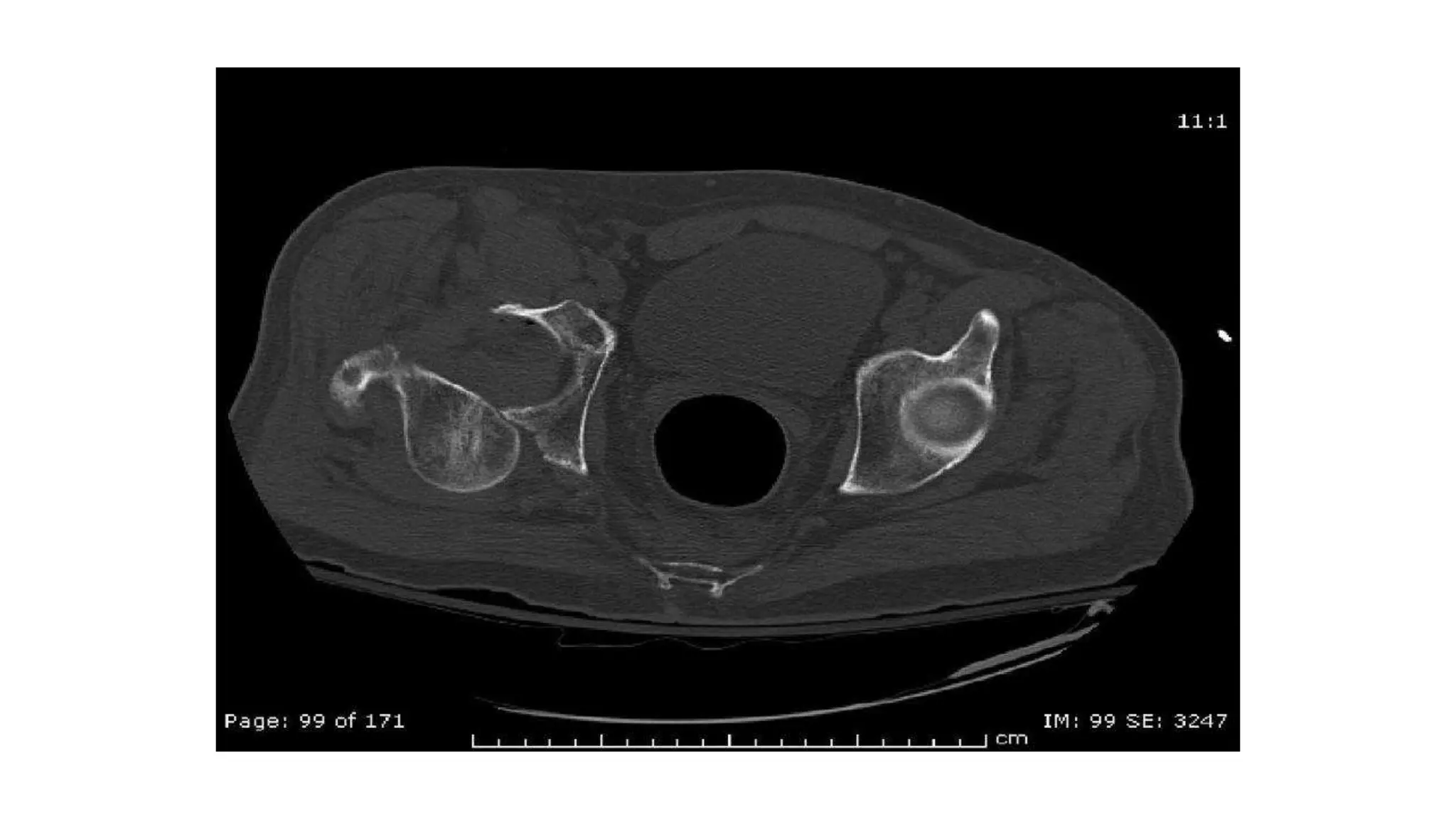 Photo Session: Posterior Hip Dislocation | PPTX