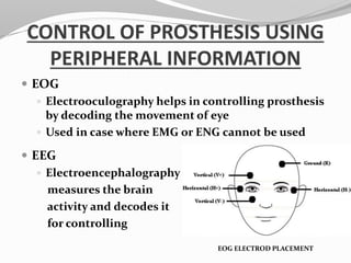 Bioelectric Prosthesis Modelling using 3D-Printing | PPTX