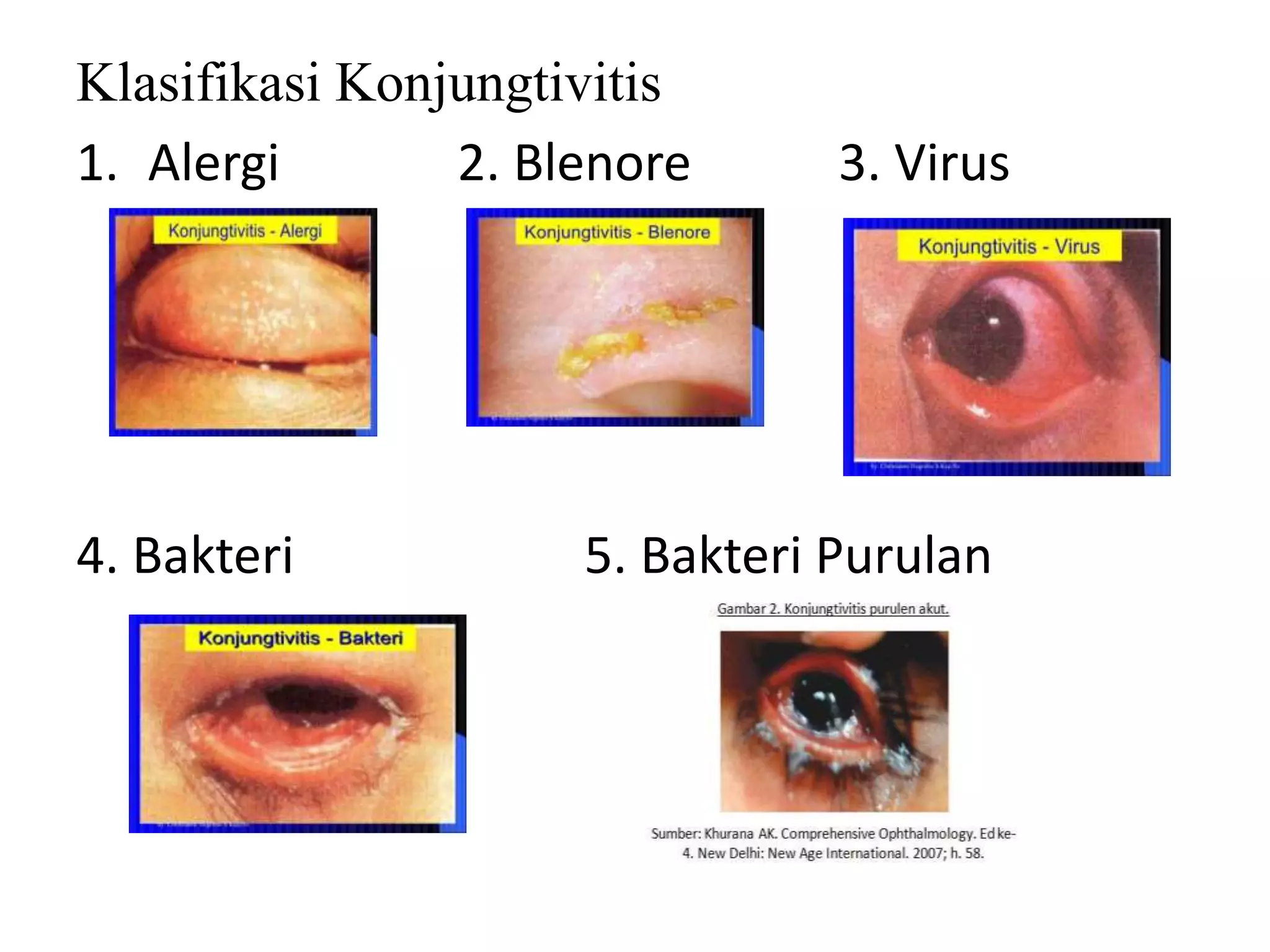 Konjungtivitis | PPTX