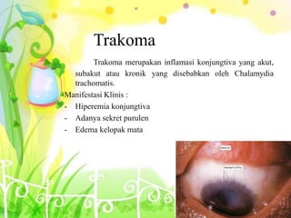 Konjungtivitis | PPTX