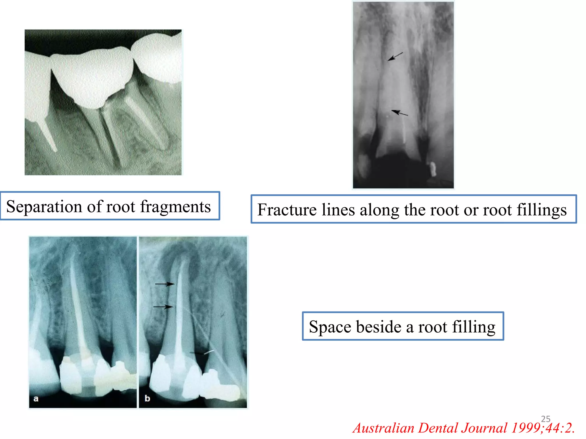 vertical root fracture and it's management ..... | PPTX