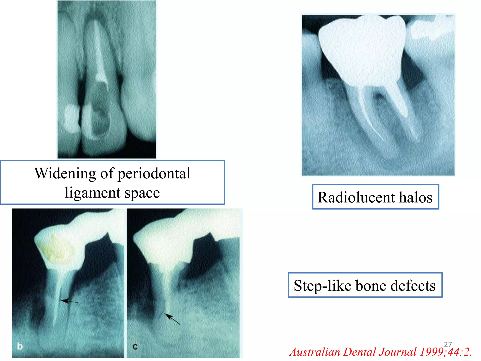 vertical root fracture and it's management ..... | PPTX