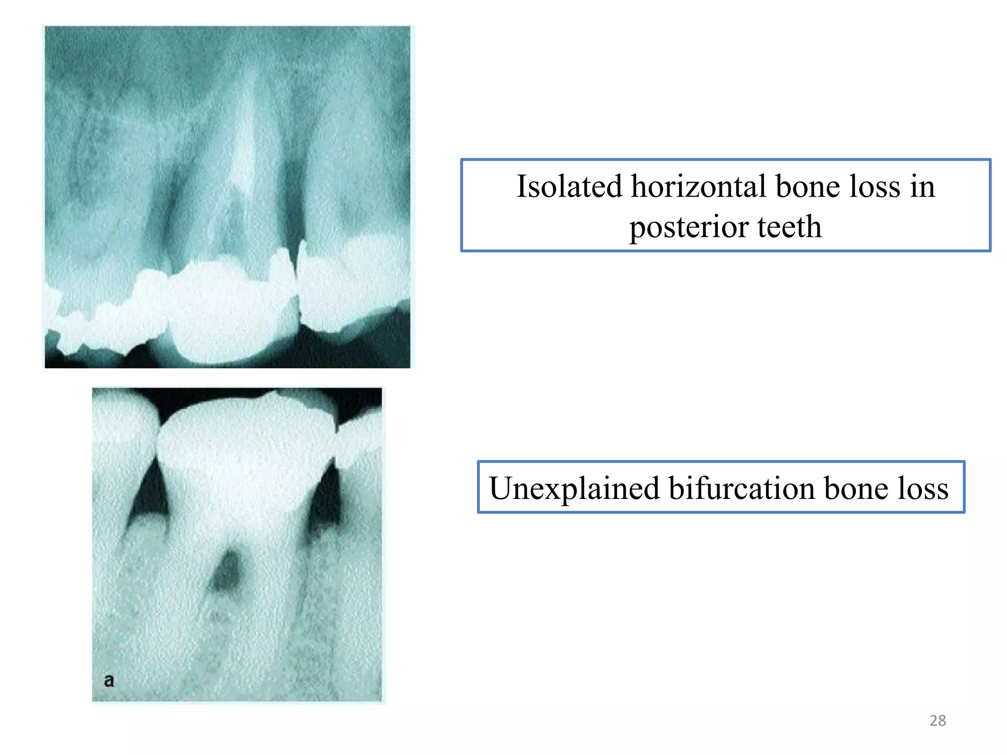 vertical root fracture and it's management ..... | PPTX