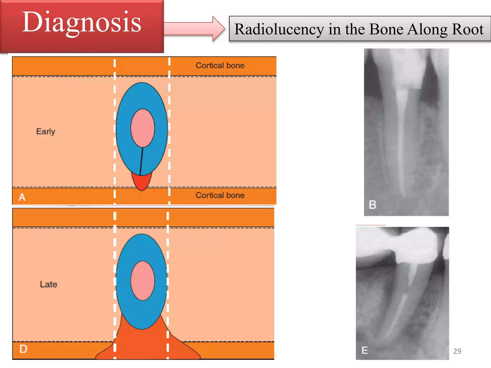vertical root fracture and it's management ..... | PPTX