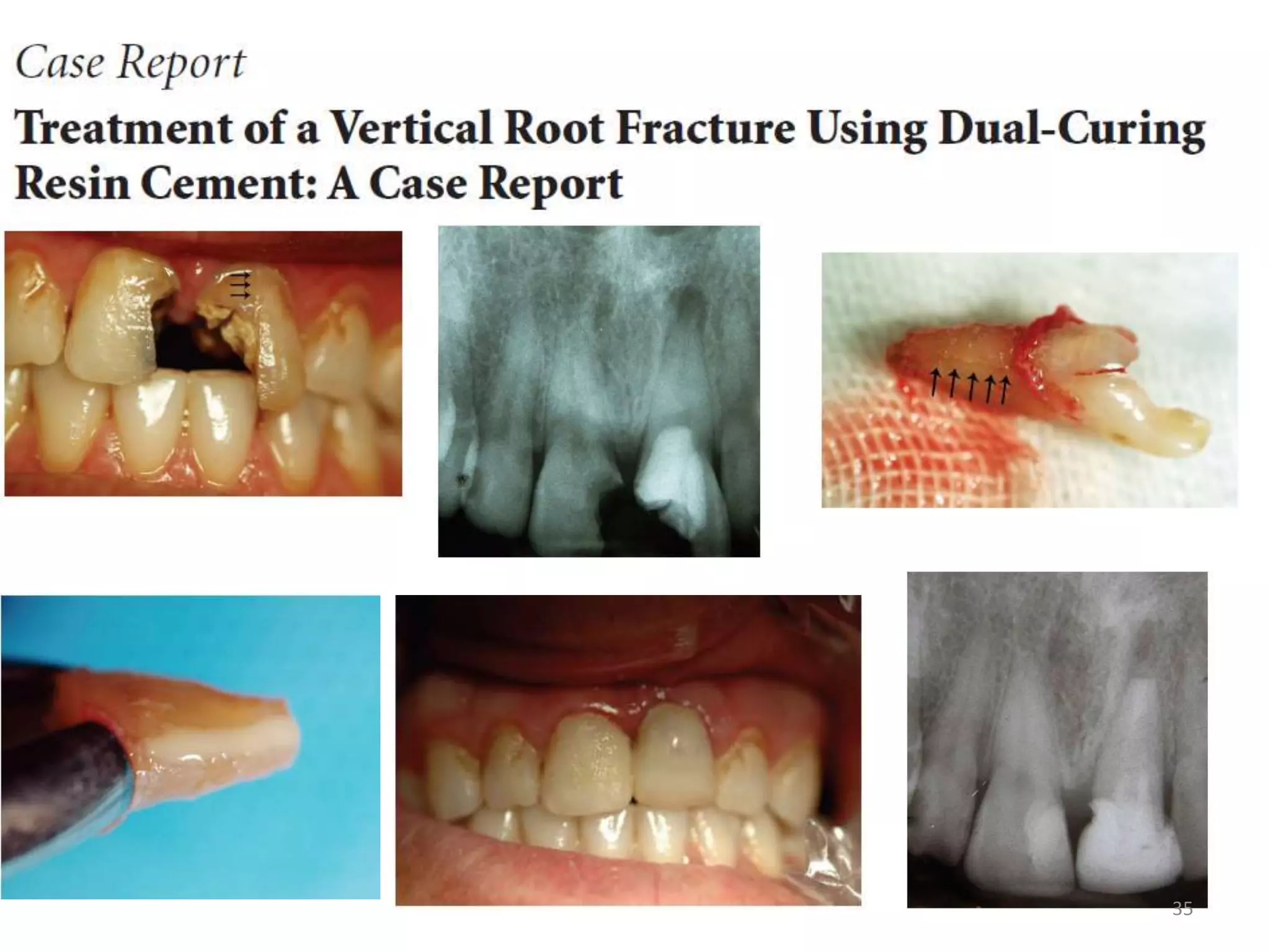 vertical root fracture and it's management ..... | PPTX