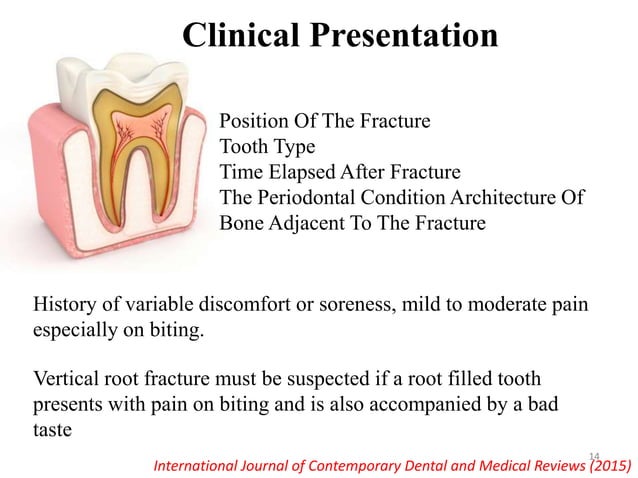 vertical root fracture and it's management ..... | PPTX | Dental Health ...