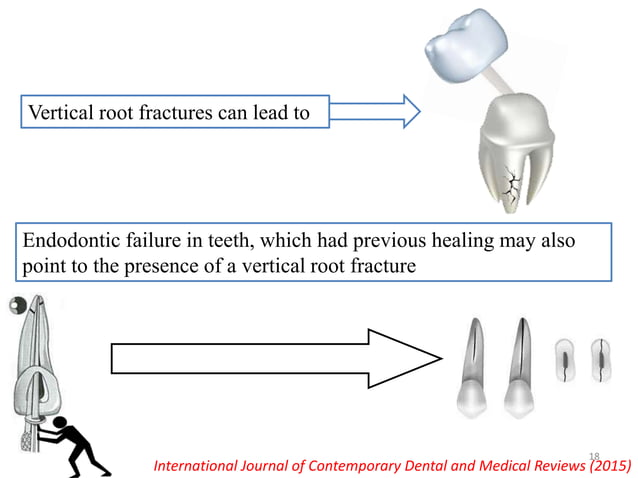 vertical root fracture and it's management ..... | PPTX | Dental Health ...