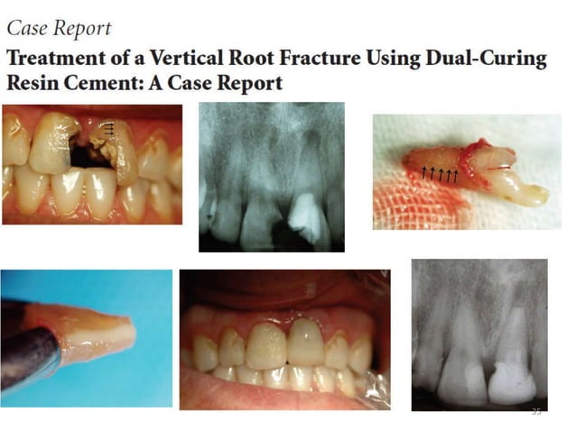 vertical root fracture and it's management ..... | PPTX | Dental Health ...
