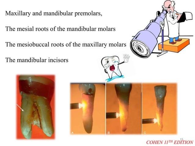 vertical root fracture and it's management .....