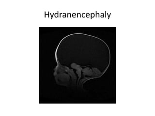 Pediatric neurology mcq | PPTX