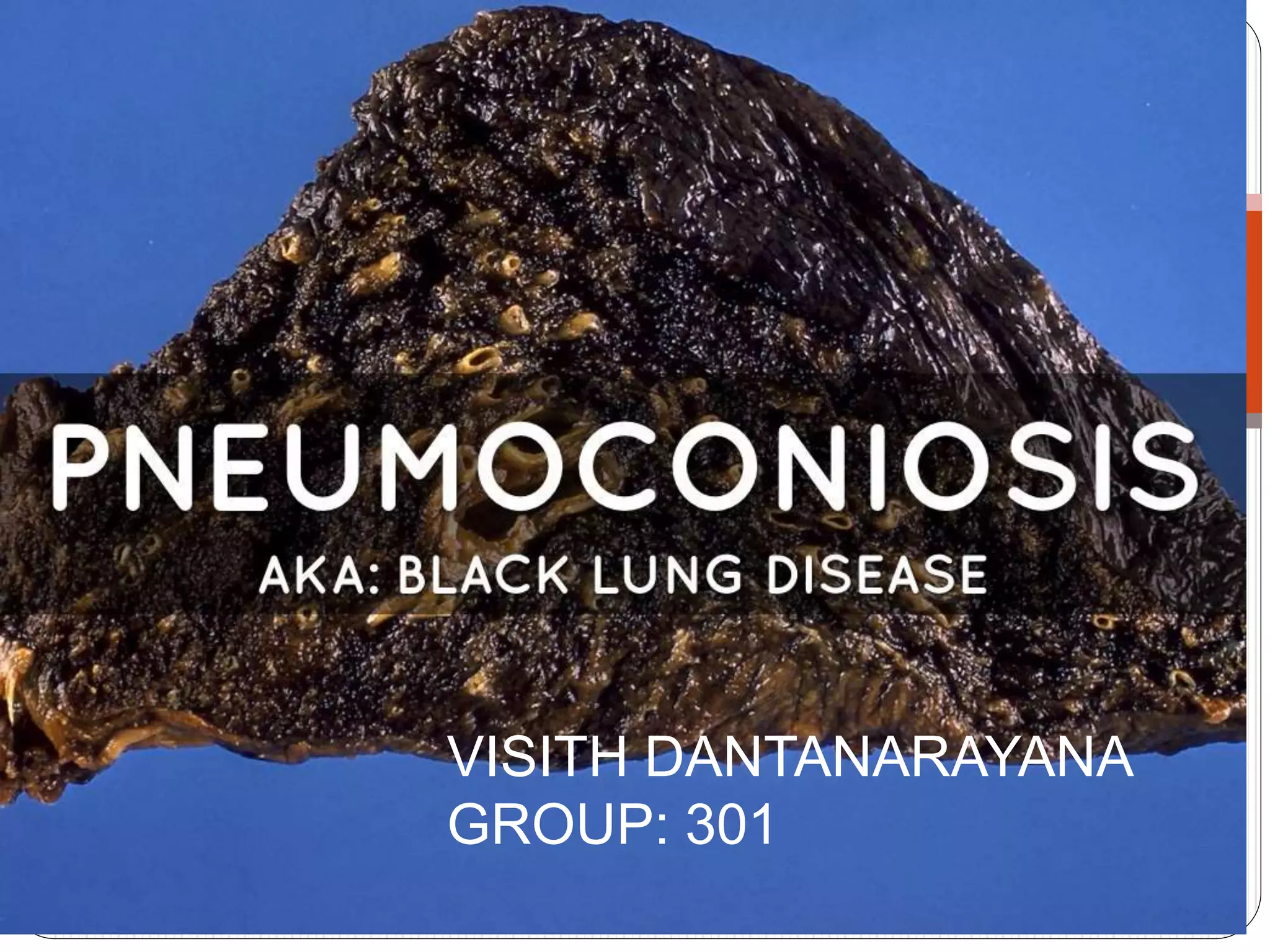 Pneumoconiosis | PPTX