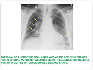 Pneumoconiosis | PPTX
