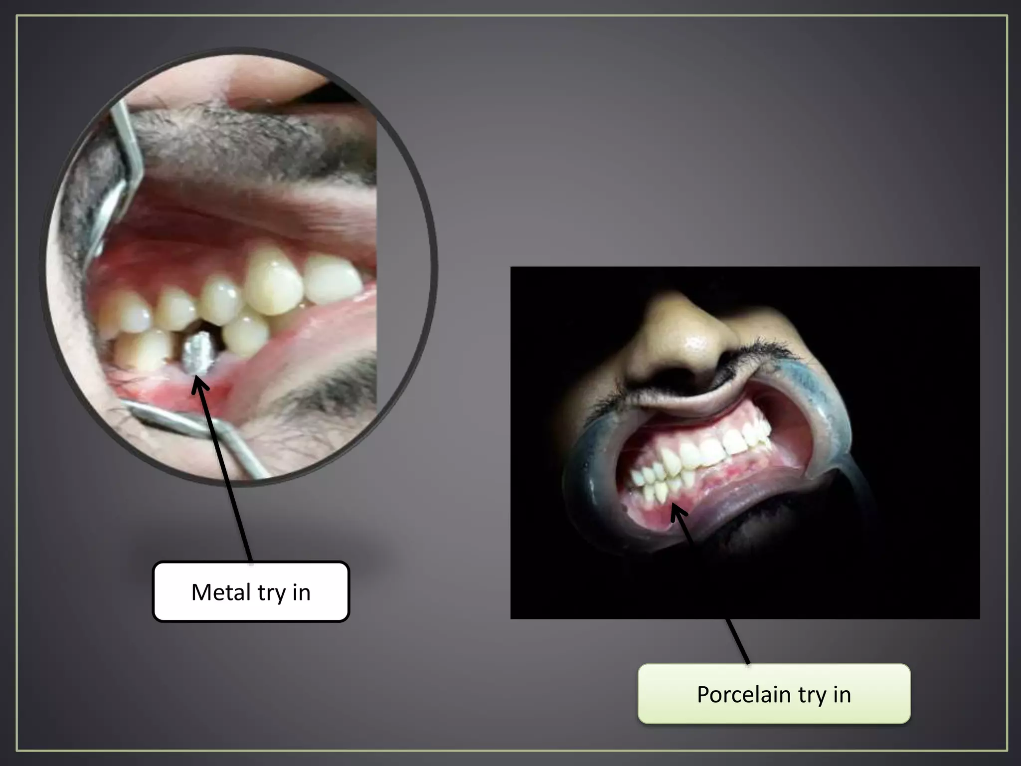 A Case Of Cross Bite Corrected By FVC In The Mandibular Right Second ...