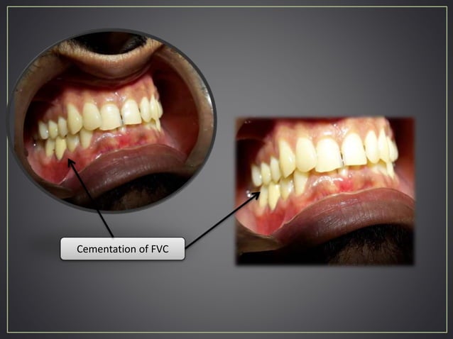 A Case Of Cross Bite Corrected By FVC In The Mandibular Right Second ...
