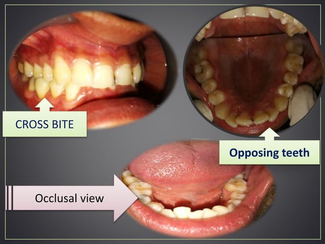 A Case Of Cross Bite Corrected By FVC In The Mandibular Right Second ...
