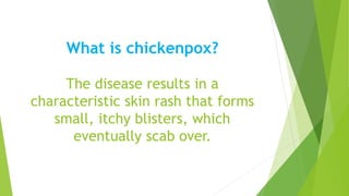Chickenpox | PPT