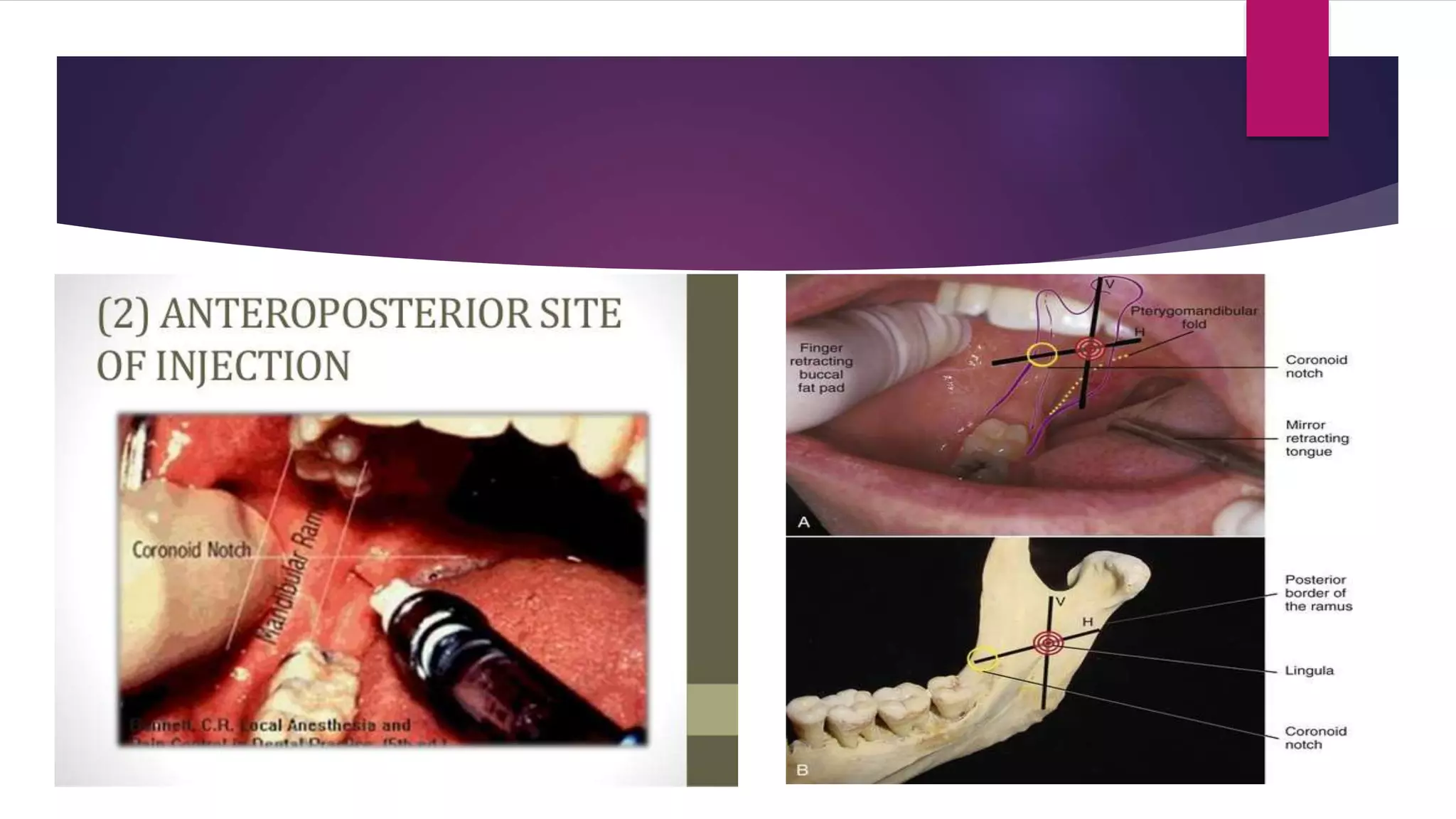 Presentation (1) of anatomical landmark of maxilla and mandible | PPTX