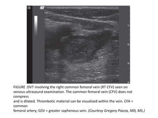 deep vein thrombosis and pe | PPTX